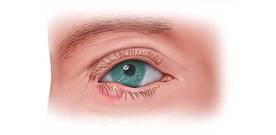 What causes styes? | Eye health education 101 – You & Eye by Dr. Nicky