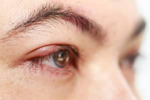 Crusty Eyelashes? Here's What Might Be Happening – You & Eye by Dr. Nicky